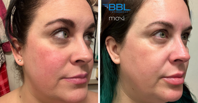 Laser Treatments - MidState Skin Institute