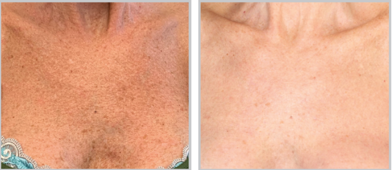 Laser Treatments - MidState Skin Institute
