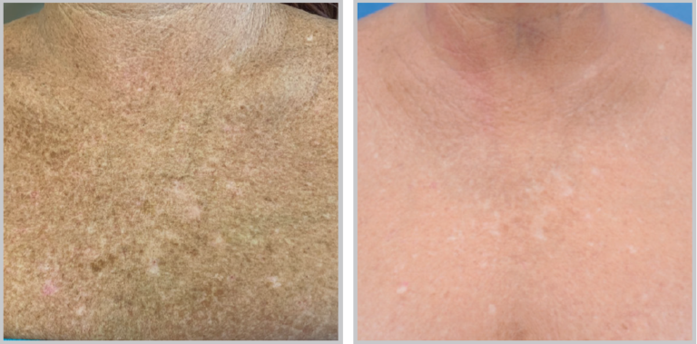 Laser Treatments - MidState Skin Institute