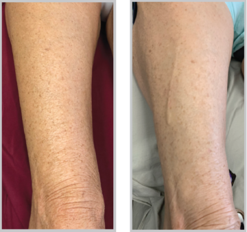 Laser Treatments - MidState Skin Institute