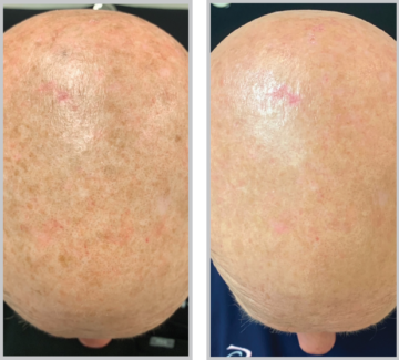 Laser Treatments - MidState Skin Institute